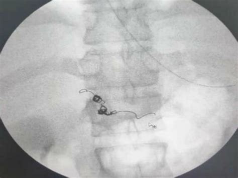 Post Embolization Angiogram Shows Coils Within The Aneurysm Sac With Download Scientific