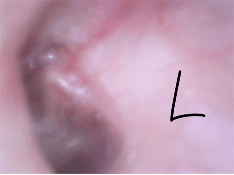 Is There Wax On My Right Eardrum Rearwax