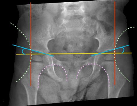 Bilateral Normal Hips Of A 3 Year Old Infant With Acetabular Index