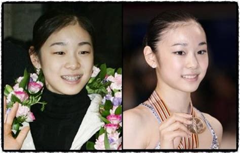 Welcome Fetishism In Korea Wearing Braces