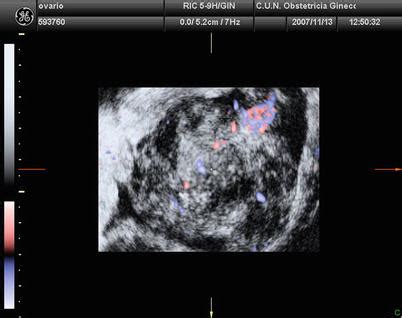 Benign Sex Cord Stromal Tumors Clinical And Ultrasound Features