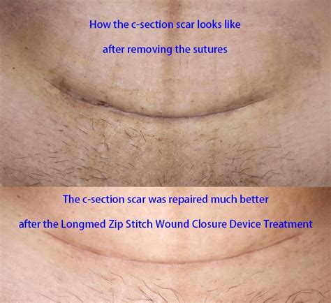 Best Care For C Section Incision At Daniel Gilmore Blog