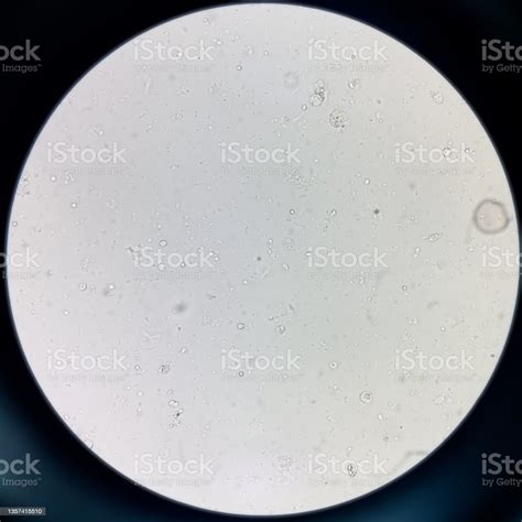 Semen Analysis Sperm Analysis On Microscopic Examination