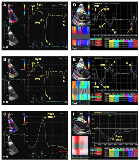Examples Of The Velocity Strain Rate And Strain Curves By Tissue