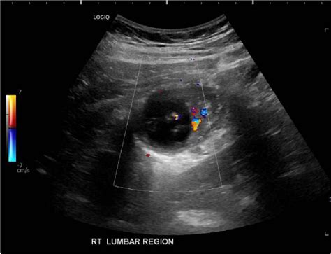 Ultrasound Image Demonstrating A Cystic Lesion With Internal