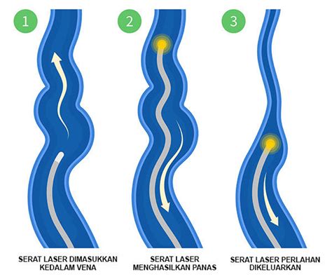 Prosedur Evla Untuk Pengobatan Varises Cara Kerja And Keunggulannya