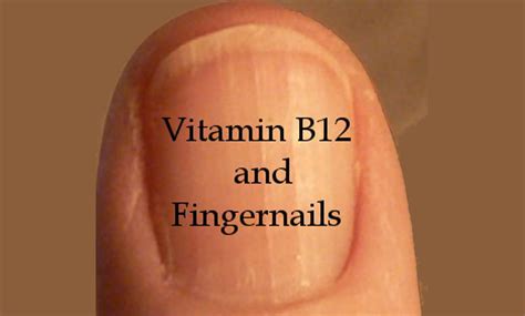 Vitamin B12 Deficiency Nails
