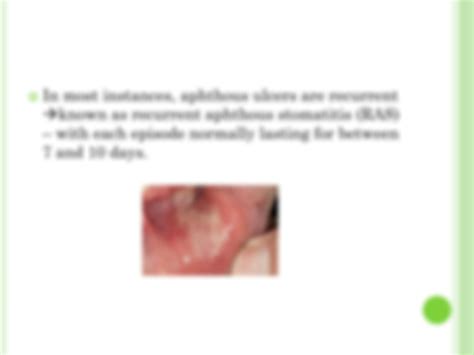Solution Aphthous Ulcer Studypool