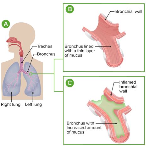 Acute Bronchitis Concise Medical Knowledge