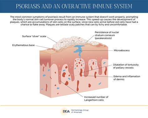Main Causes Of Plaque Psoriasis At Sebastian Montefiore Blog