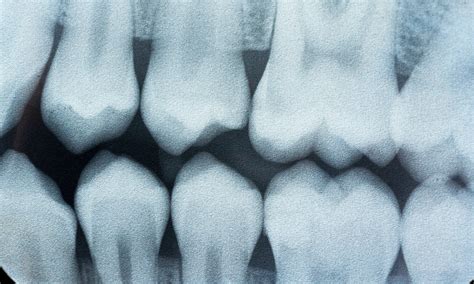 Why Tooth Banking Might Just Be The Next Wave In Stem Cell Research