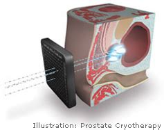 Cryotherapy Australia Prostate Cryotherapy Treatment Performed At