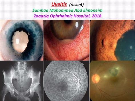 Uveitis Recent Ppt
