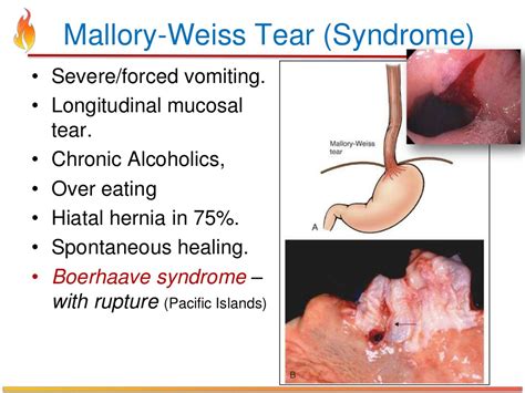 Mallory Weiss Ulcer At Leroy Olson Blog