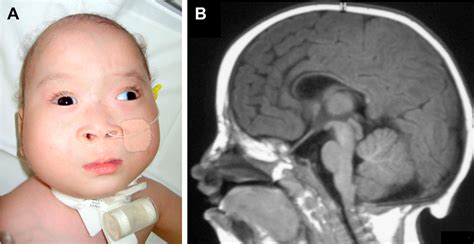 Figure 1 From Phenotypic Overlapping Of Trisomy 12p And Pallister Killian Syndrome Semantic