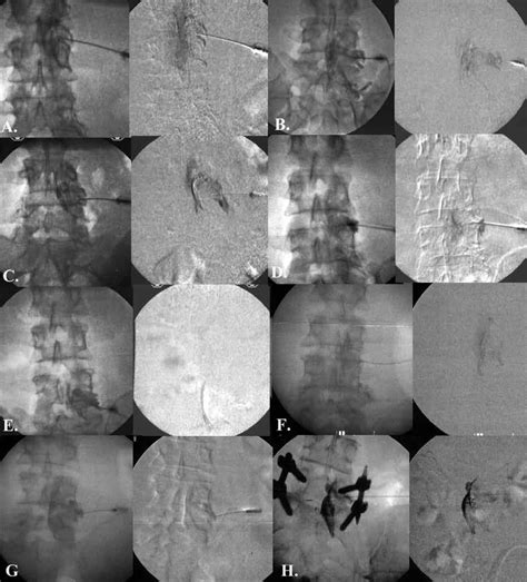 Contrast Medium Pattern Produced By Alternative Tfesi Approach