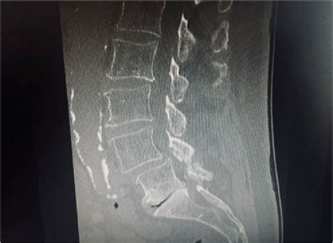 Sagittal Computed Tomography Ct Image Demonstrating Severe Central