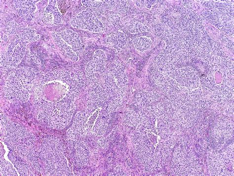 Pathology Outlines Adenocarcinoma Overview