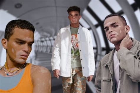 Daniel Ruenes Rompe Estándares Así Es Ser Modelo Con Vitíligo En México E