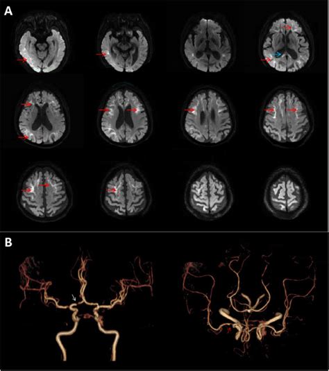 Neuronal Intranuclear Inclusion Disease Complicated By Acute Middle