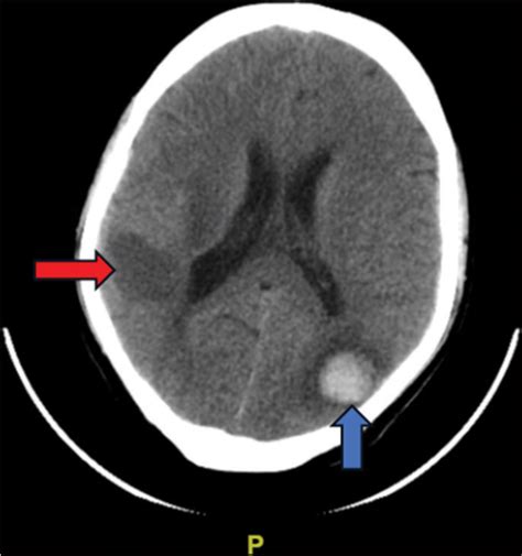 Unveiling The Mystery Infective Endocarditis As An Etiological Cause