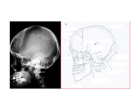 Lateral Skull X Ray Anatomy Film X Ray Skull Image And Photo Free
