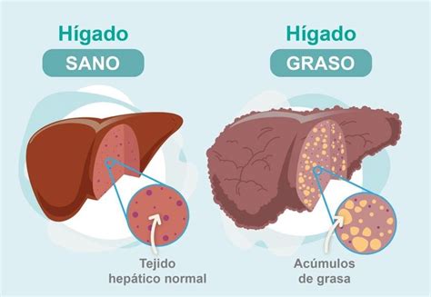 Qué Debes Saber Sobre La Enfermedad Del Hígado Graso Ozizg