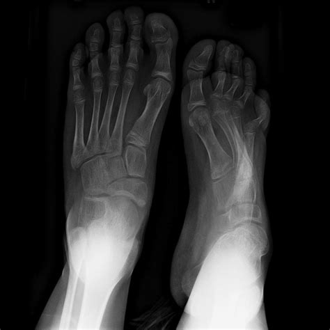 Congenital Talipes Equinovarus Buyxraysonline