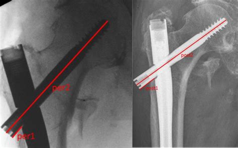 Calculation Of Lag Screw Displacement By Comparing Measurements In The
