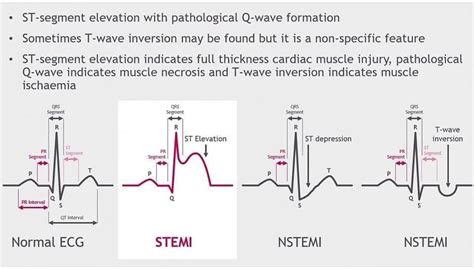 Ecg Stemi Nstemi ️if There Dr Mehmood Khan Afriidi Facebook
