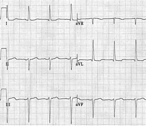 Left Anterior Fascicular Block Lafb • Litfl • Ecg Library Diagnosis