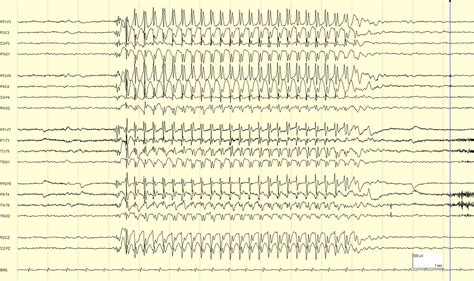 Typical Absence Seizure