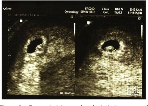 Figure 2 From Chorionic Bump In First Trimester Sonography Semantic