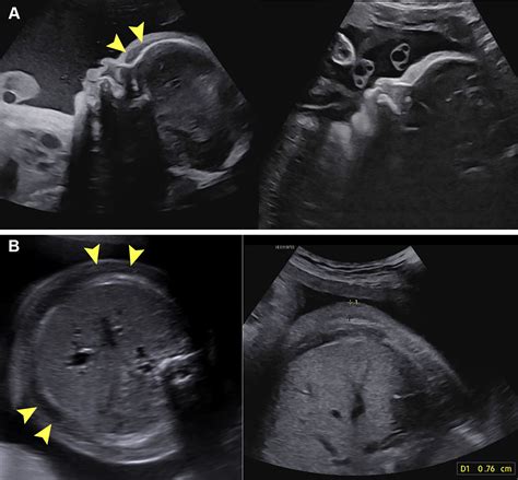 Hydrops Ultrasound Features
