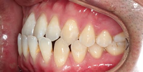 Teeth Misalignment Malocclusion Types Causes And Fixes