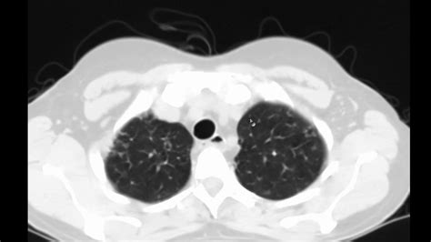 Systemic Sclerosis With Ild Uip Pattern Youtube