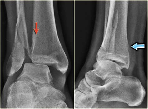 The Radiology Assistant Ankle Fractures Weber And Lauge Hansen