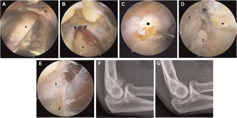 Mohamed A Imam On Linkedin Revision Arthroscopic Osteocapsular