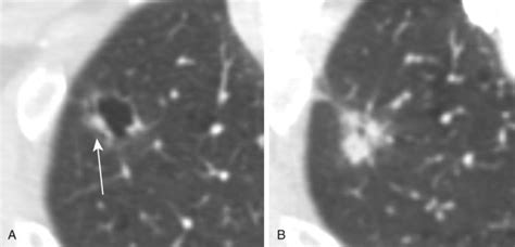 Incidental Pulmonary Nodule Clinical Tree
