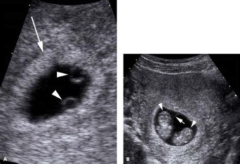 5 Week Ultrasound Identical Twins