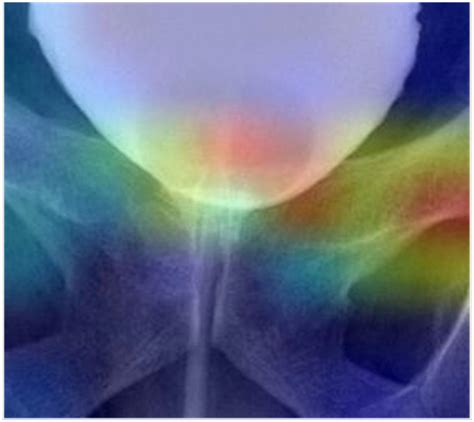 Recognition Of Postoperative Cystography Features By Artificial