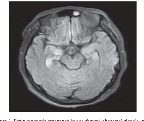 Figure 1 From Fulminant Bilateral Acute Retinal Necrosis Syndrome Associated With Viral
