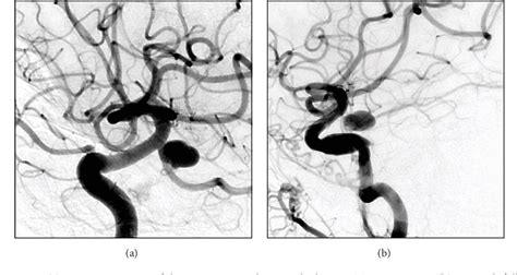 Figure 1 From Failure Of The Pipeline Embolization Device In Posterior