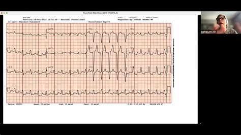 Stemi Part 1 Only You Can Decide Youtube