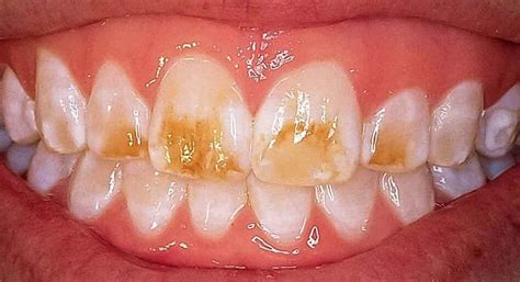 Hypocalcification Of Teeth Causes Symptoms Treatments Teethandtooth