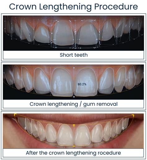 Crown Lengthening Procedure In Midtown Manhattan Nyc
