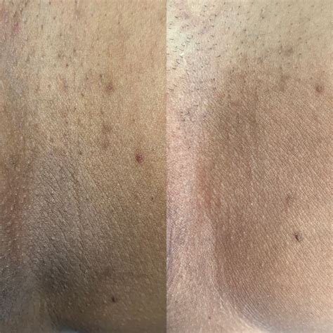 Anal Bleaching And Skin Lightening