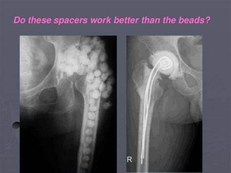 Antibiotic Cement Spacer For Infected Hip Joint Replacement Thr Sur…
