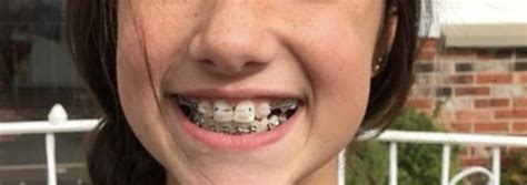 Dental Braces For Teens Unlock The Secrets To A Perfect Smile Lema