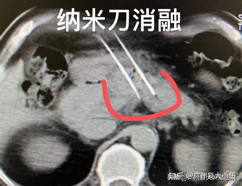 胰腺癌化疗后局部进展怎么办？ 知乎